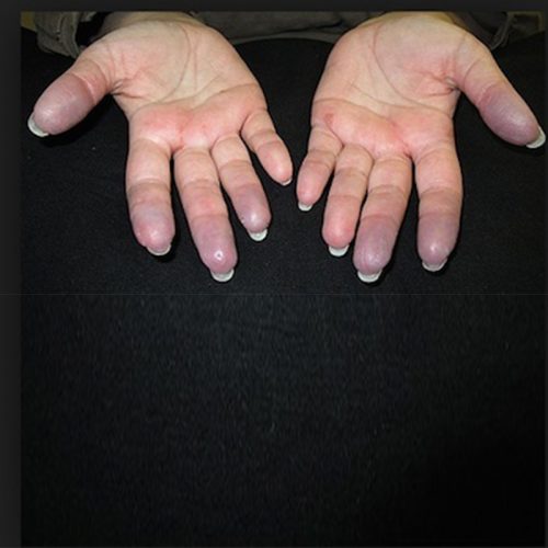 What is Vasculitis? Symptoms and Treatment in Australia.