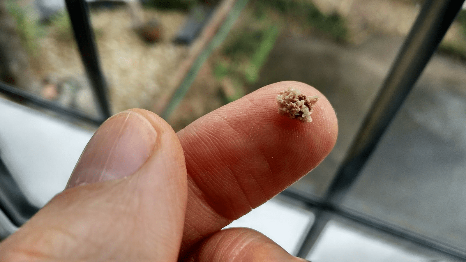 Symptoms of Kidney and Gallbladder Stones | Yatan Ayurveda